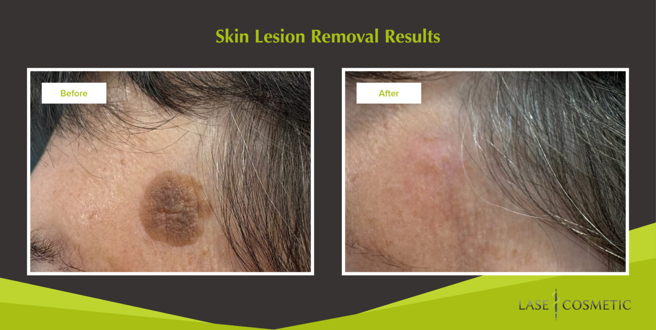Skin Lesion Removal: What It Involves & When to Consider It