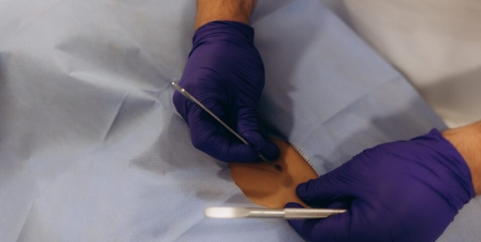 Skin Lesion Removal: What It Involves & When to Consider It